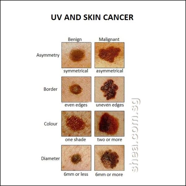 Moles Vs Skin Cancer Shea Singapore 3494